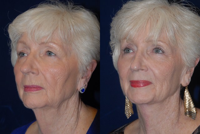 Direct Neck Lift - William D Anderson MD